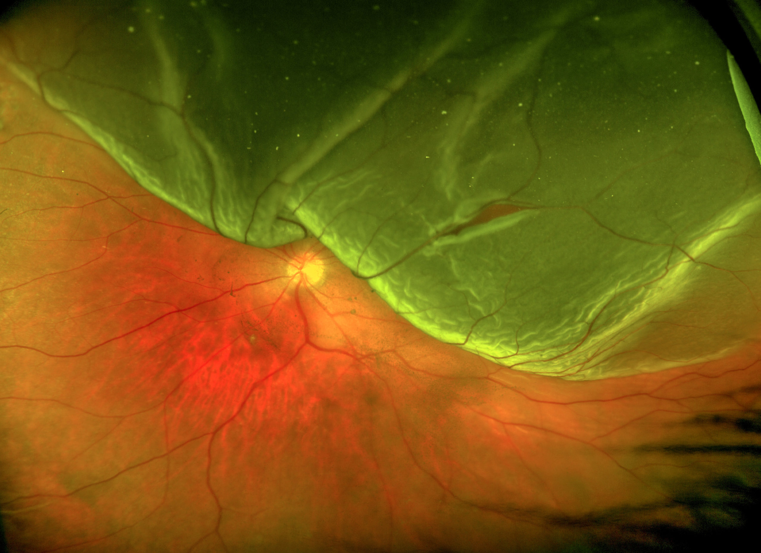 EL BUEN TIEMPO, EL DESPRENDIMIENTO DE RETINA Y SUS CAUSAS II ...