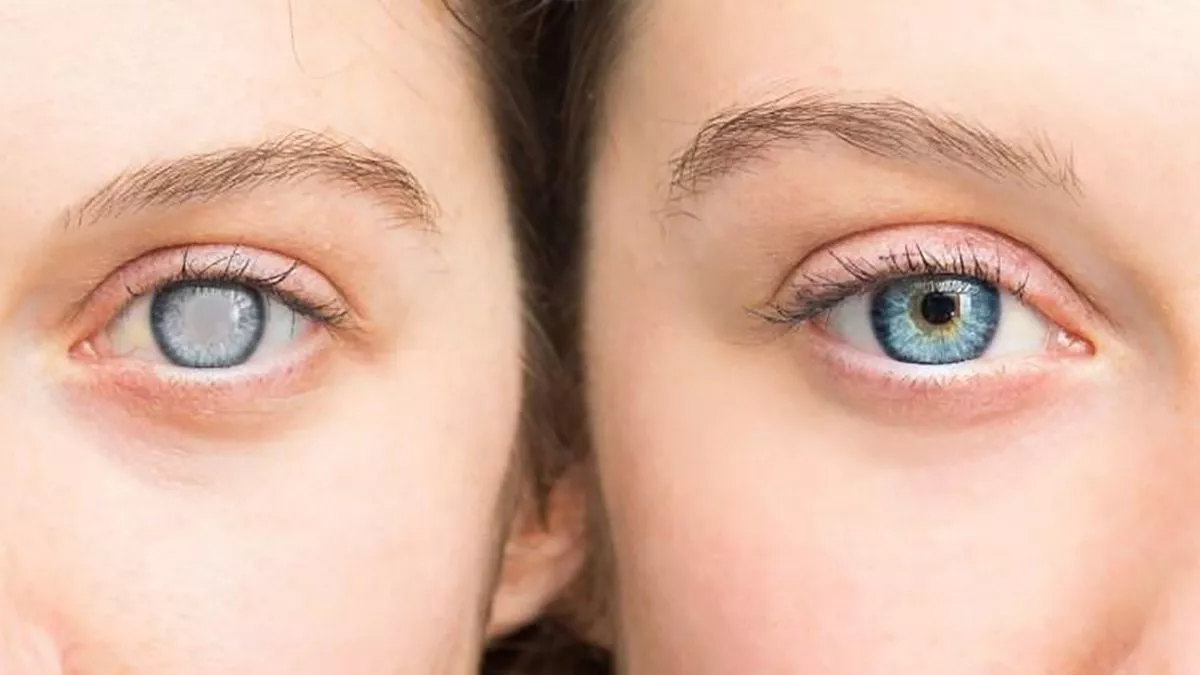 Operar cataratas en Valencia - Instituto de la RETINA VALENCIA